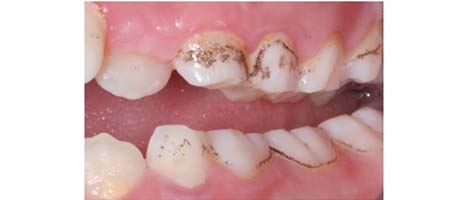Manchas negras en los dientes - Cuidado Dental PersonalizadoCuidado ...